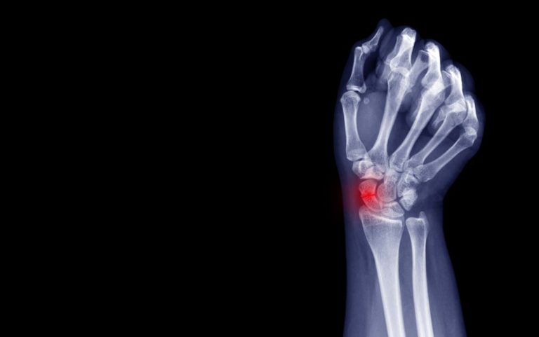 Scaphoid Fracture - Sports Medicine Information