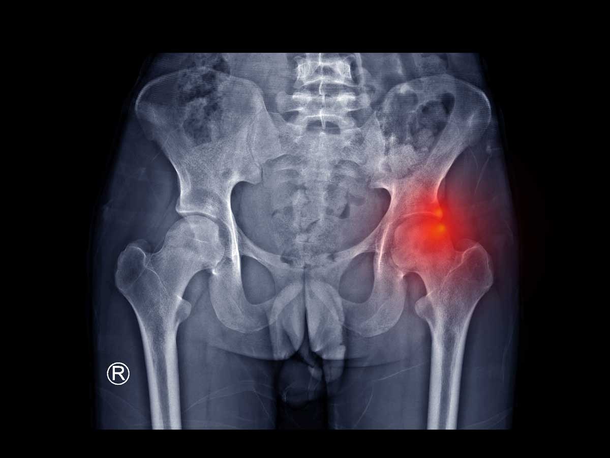Anterior Hip Impingement - Sports Medicine Information