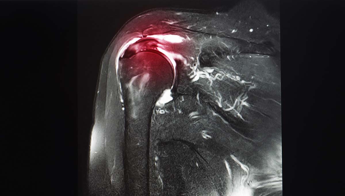 Rotator Cuff Tears - Sports Medicine Information