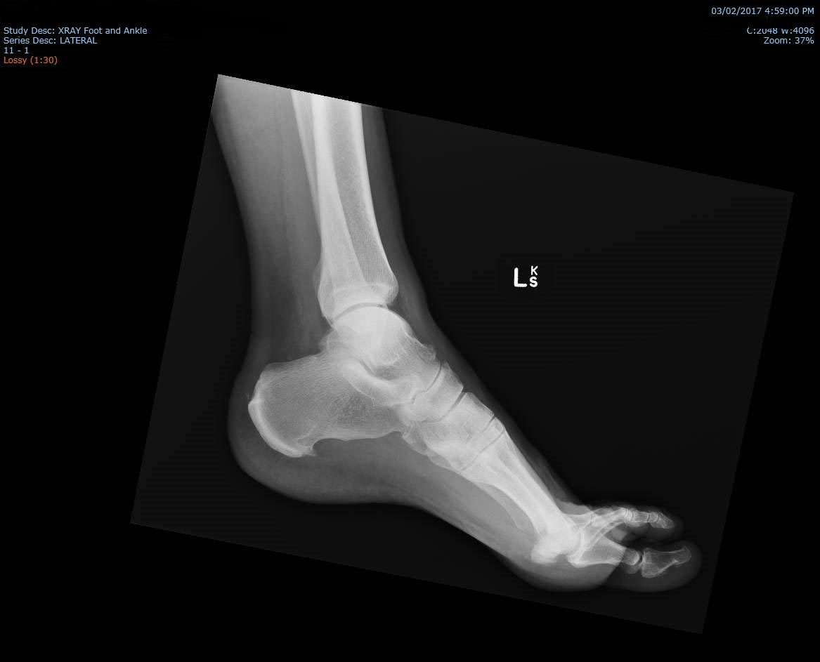 Ankle Impingement - Sports Medicine Information